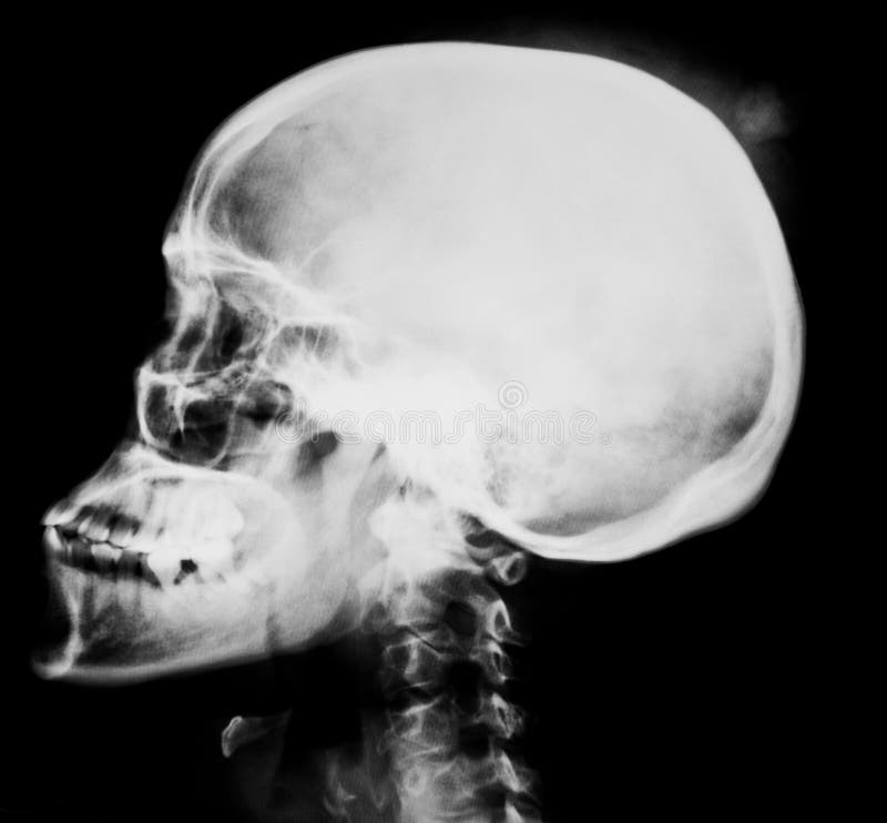 Human head x-ray film stock image. Image of examine, hospital - 15761847