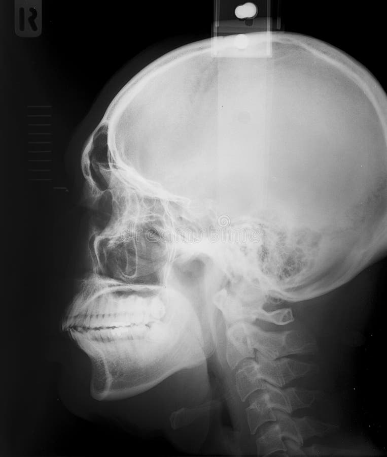 Human head x-ray film stock photo. Image of skull, transparent - 27531258