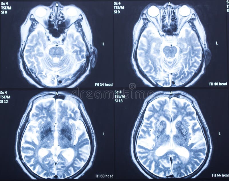 Human head X-ray result stock image. Image of computer - 58121121