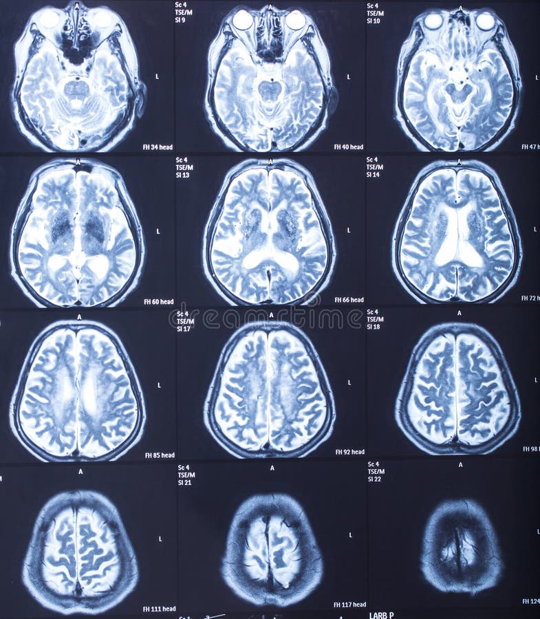 Human head X-ray result stock image. Image of power, medical - 58121391