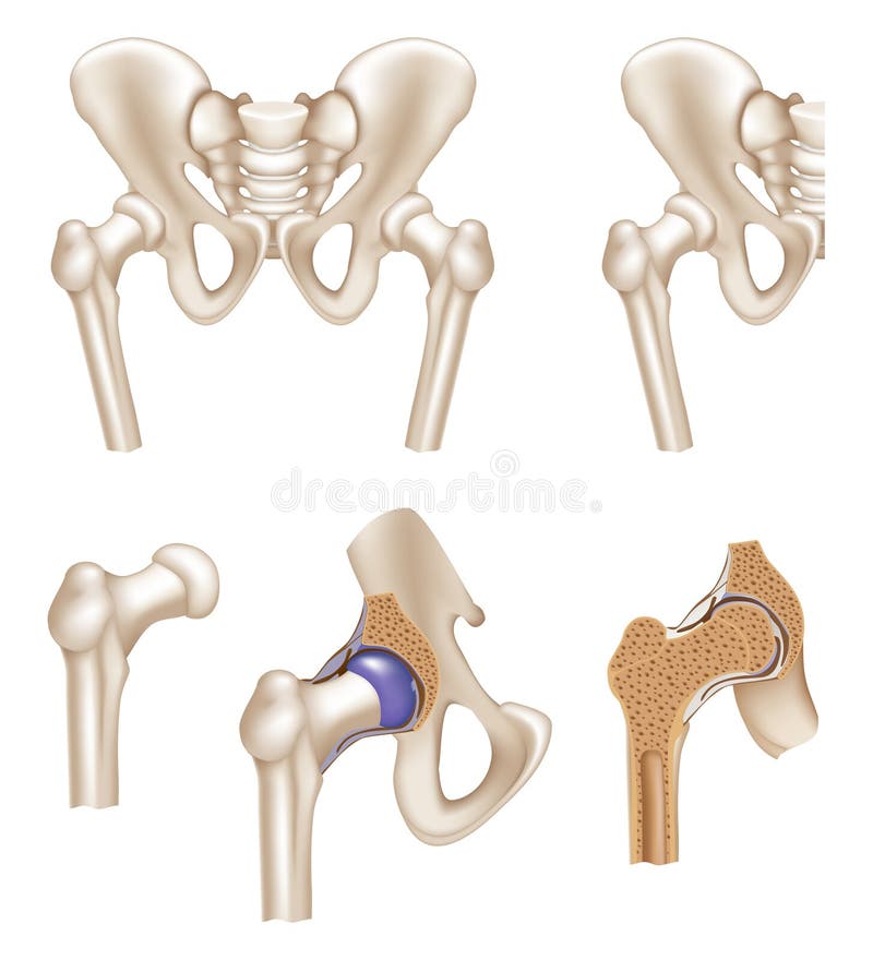 Hip dislocation stock vector. Illustration of anatomical - 28110054