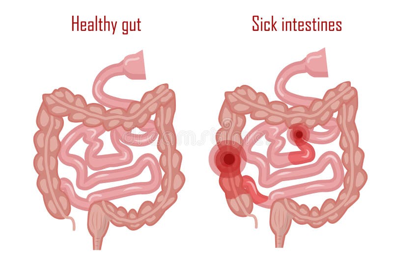 Human Intestine. Healthy and Diseased Intestine, the Digestive System ...