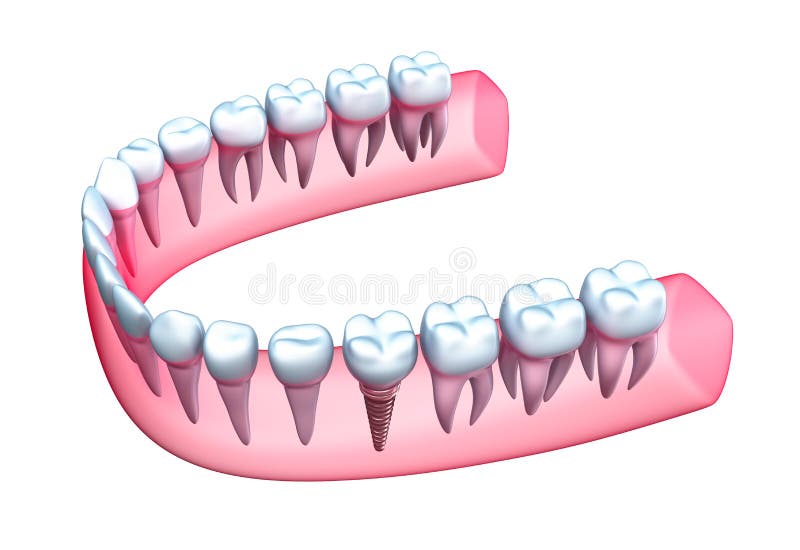 Human Jaw Model with Teeth and Implant. Stock Illustration ...