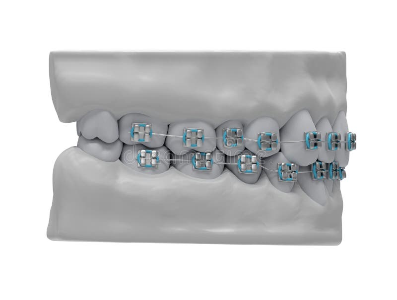 Classic Metal Braces, Side View Stock Illustration - Illustration of ...