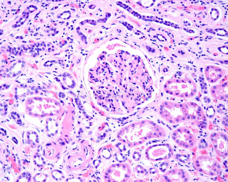 Human Kidney. Diabetic Nephropathy Stock Photo - Image of ...