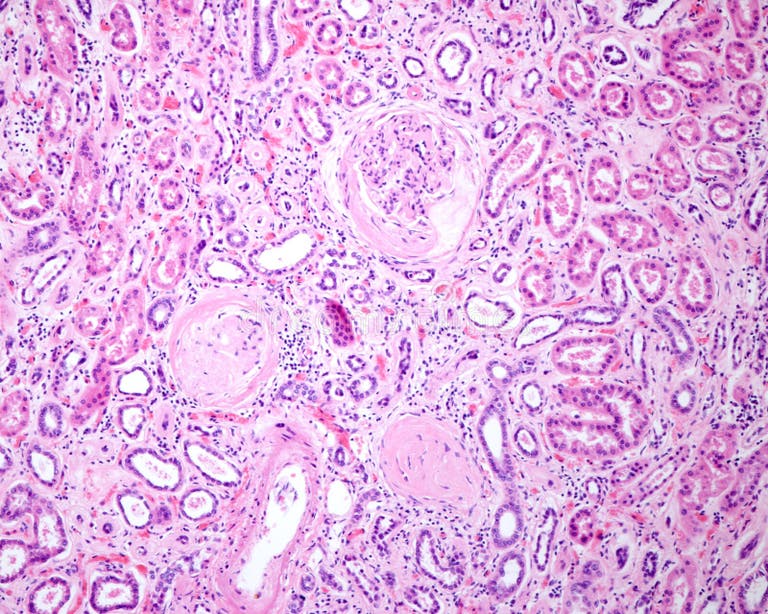 162 Diabetic Stage Five Stock Photos - Free & Royalty-Free Stock Photos ...