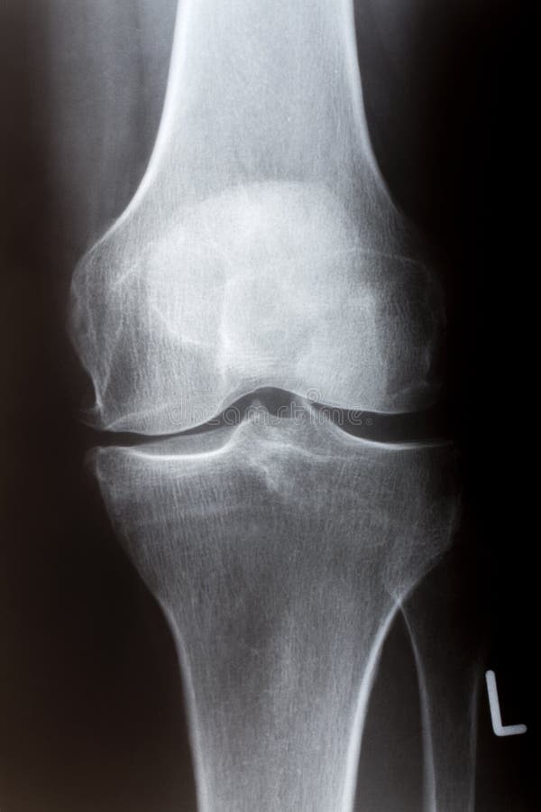 Human knee in front stock image. Image of skeleton, painful - 109346541