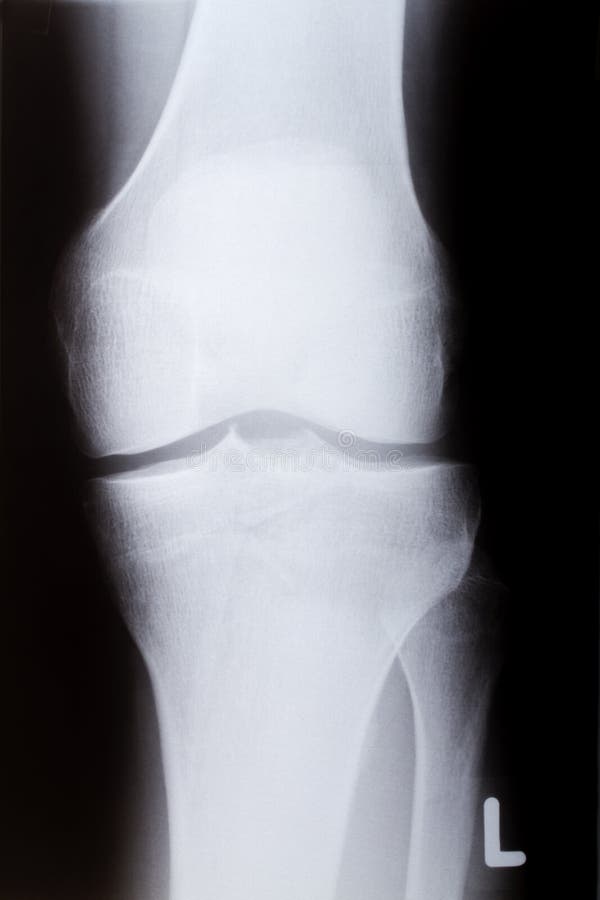 Human knee in front stock image. Image of skeleton, painful - 109346541