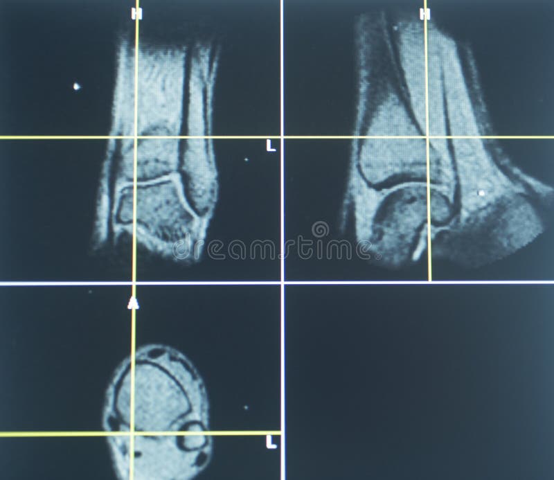 Human Knee Open MRI CT Scan Stock Photo - Image of expertise ...