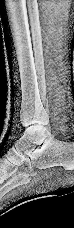 Human Left Foot. X Ray Lateral View Stock Image - Image of skeleton ...