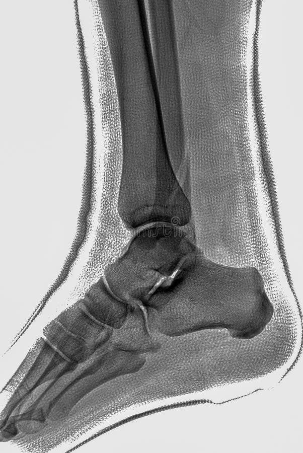 Human Left Foot. X Ray Lateral View Stock Photo - Image of science ...