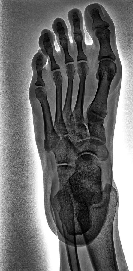 Human Left Foot. X Ray Lateral View Stock Photo - Image of science ...