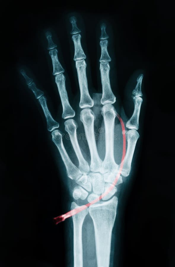 X-ray picture left hand stock image. Image of original - 20967069