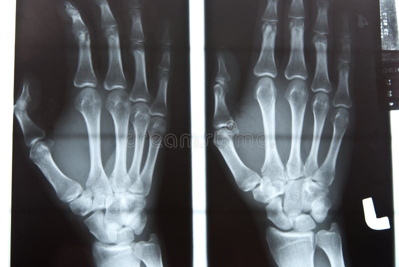 X Ray Hand Different X Rays Shot Of Human Body Part, Set. Various