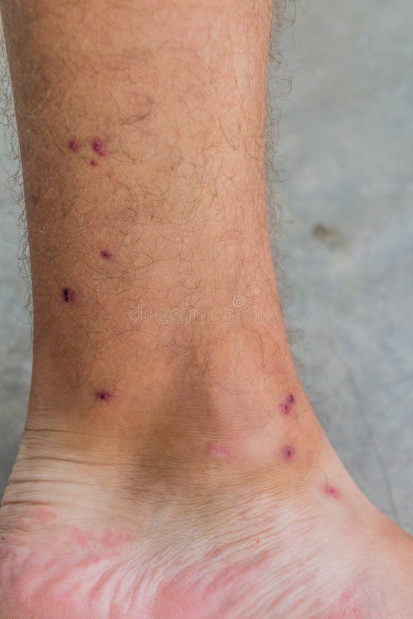 Human leg bitten by leech stock image. Image of human - 223502759
