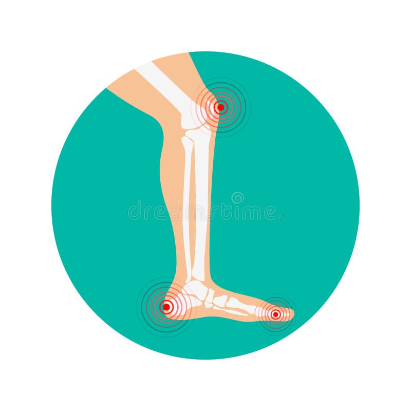 Human Leg Pain Zones. Design Elements for Infographic. Stock Vector ...