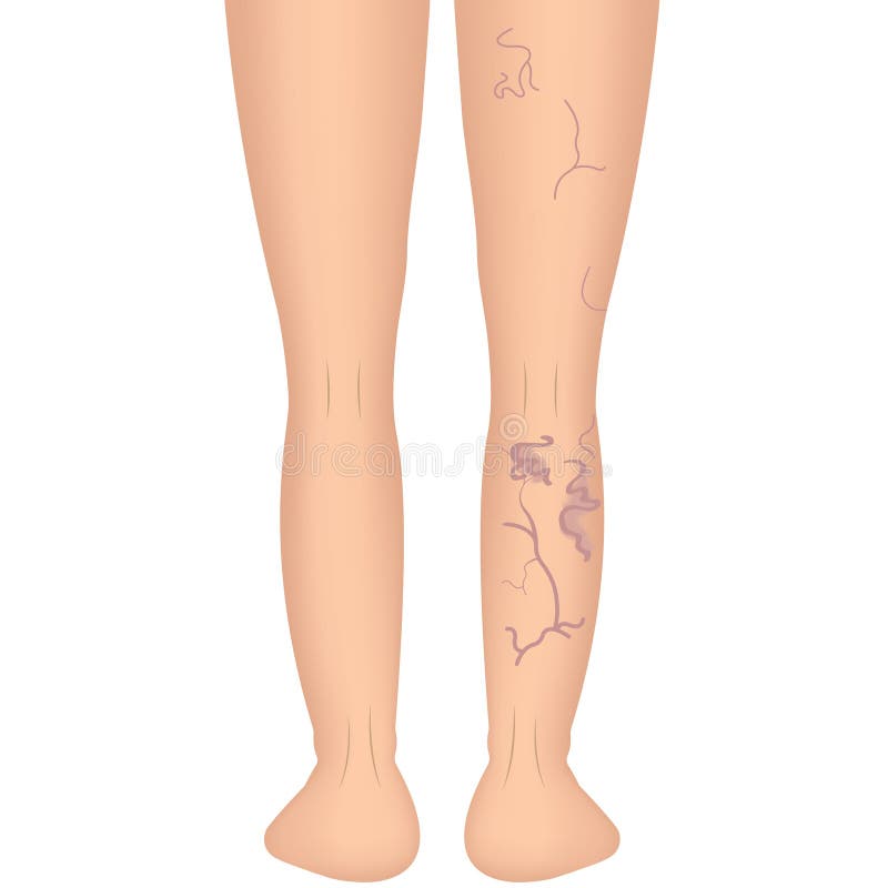 Human Legs with Health Problems. Varicose Veins. Bruise, Hematoma ...