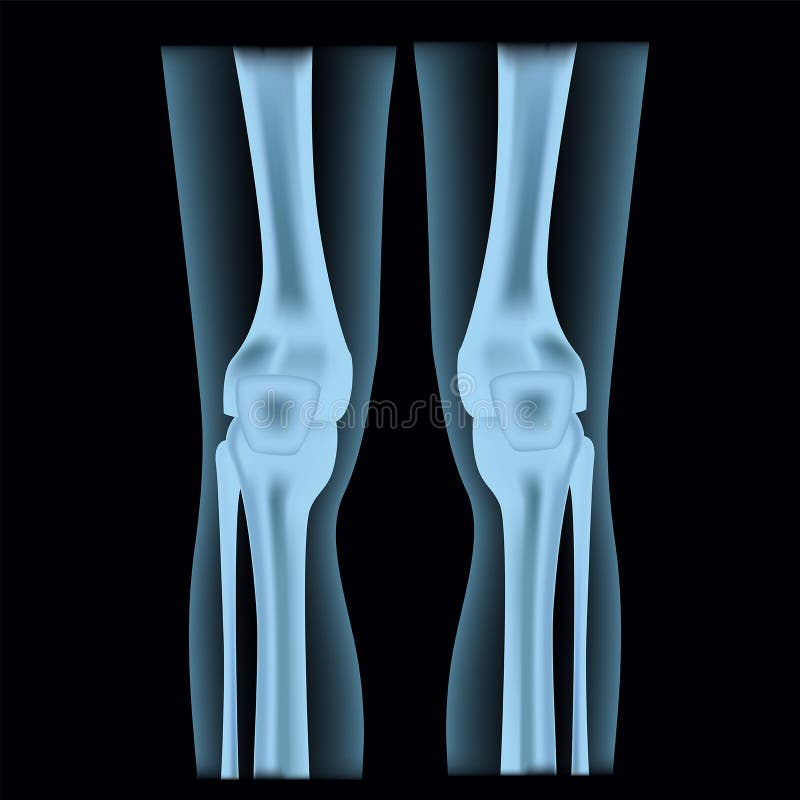 Human Legs in X-rays. Knee Joints Stock Vector - Illustration of ...