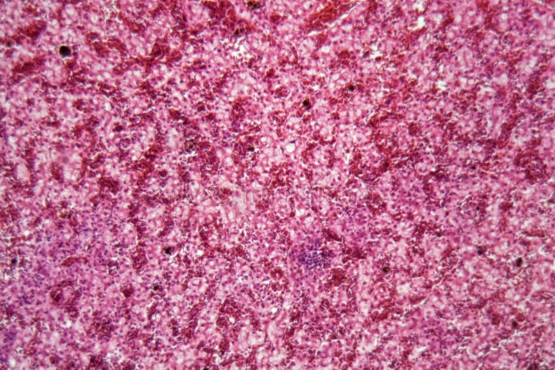 Human Liver Cells with Cancer Stock Photo - Image of metastasis, tumor ...