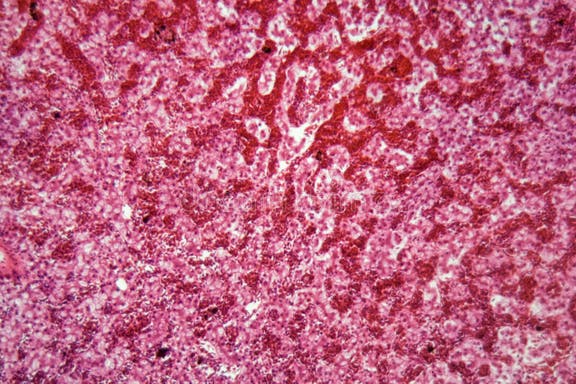 Human Liver Cells with Cancer Stock Image - Image of liver, texture ...