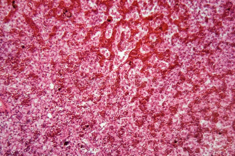 Human Liver Cells with Cancer Stock Image - Image of liver, texture ...