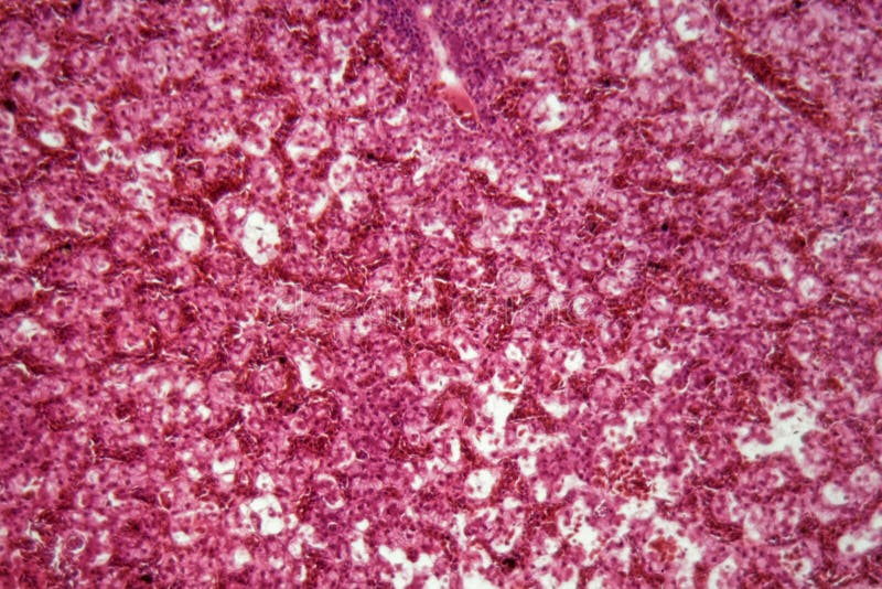 Human Liver Cells with Cancer Stock Image - Image of microscopic, cell ...