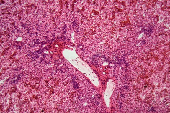 Human Liver Cells with Cancer Stock Photo - Image of medicine, death ...