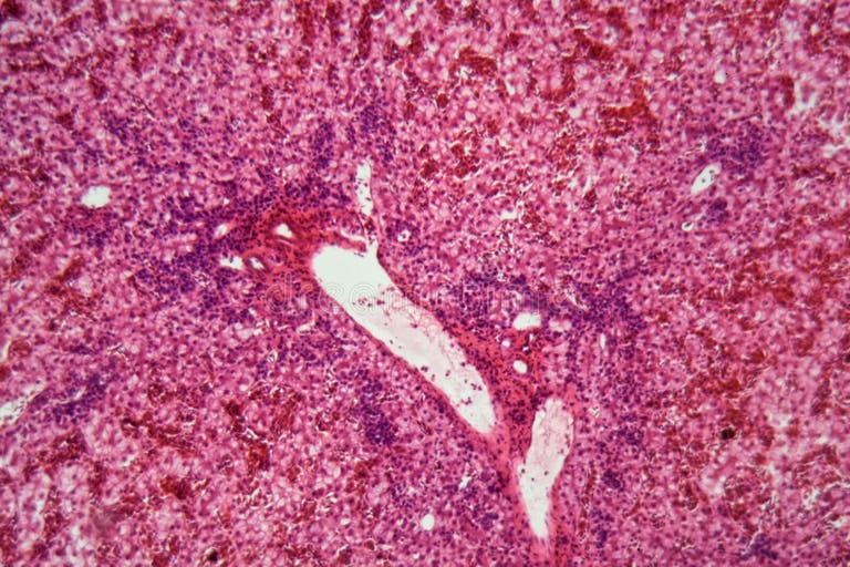 Human Liver Cells with Cancer Stock Photo - Image of medicine, death ...