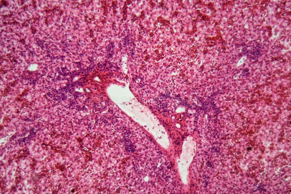 Human Liver Cells with Cancer Stock Photo - Image of medicine, death ...