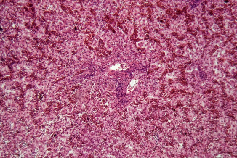 Human Liver Cells with Cancer Stock Photo - Image of microscopy ...