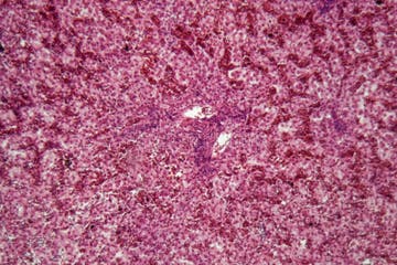 295 Liver Cancer Cells Stock Photos - Free & Royalty-Free Stock Photos ...