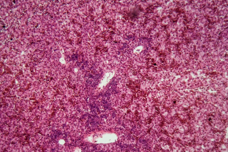 Human Liver Cells with Cancer Stock Image - Image of pathology ...