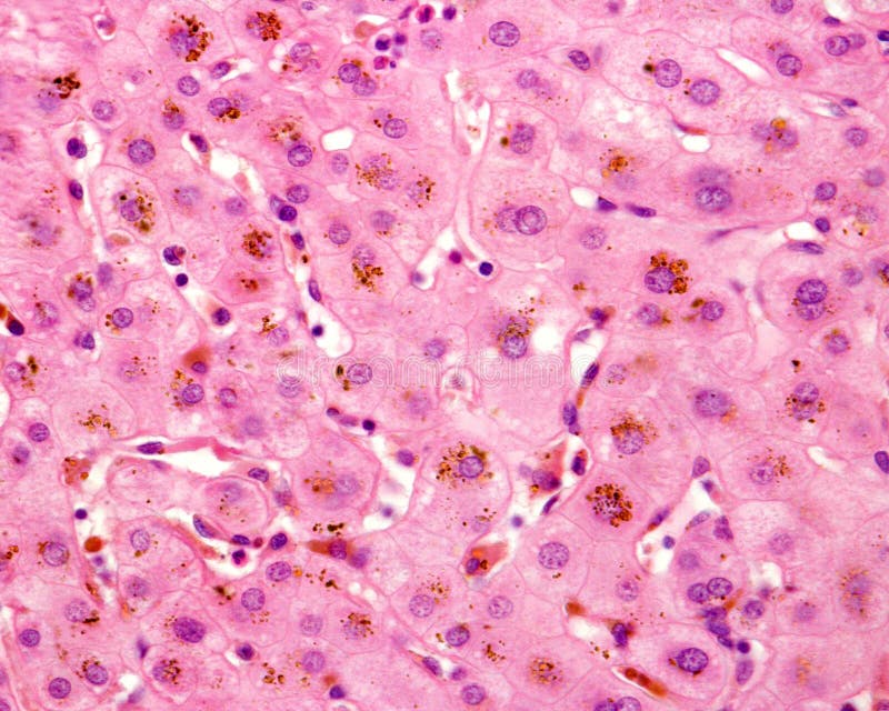 Human liver. Cholestasis stock photo. Image of microscopy - 242799084