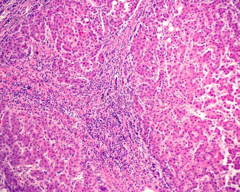 277 Liver Fibrosis Stock Photos - Free & Royalty-Free Stock Photos from ...