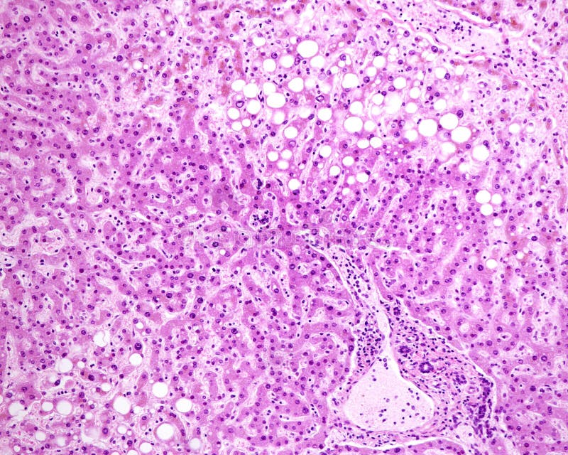 Human liver. Hepatic cords stock image. Image of photomicrograph ...