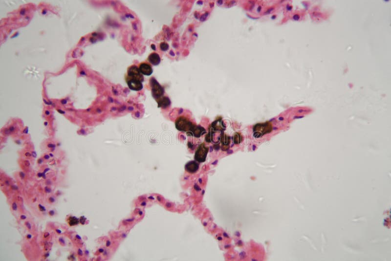 Human Lung Tissue with Dust and Coal Particles Under the Microscope ...