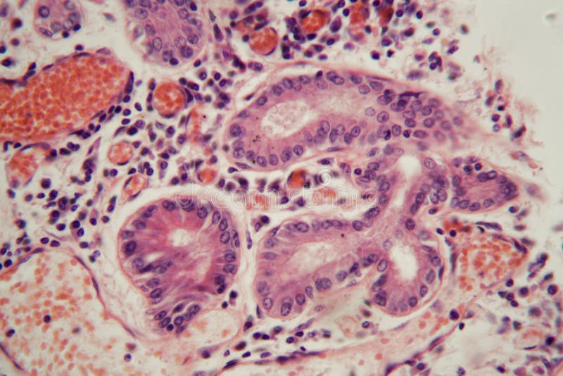 Human Lung Tissue with Pulmonary Embolism Under a Microscope Stock ...