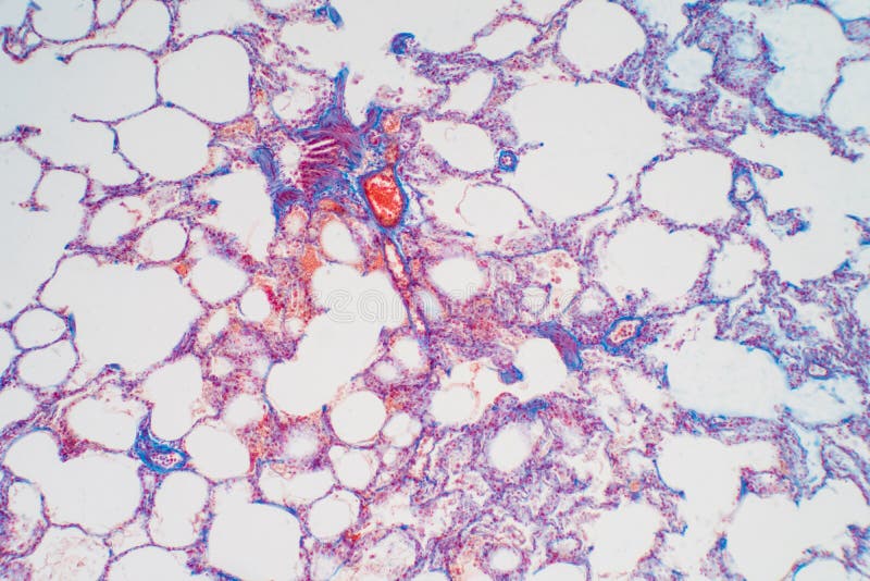 Human Lung Tissue Under Microscope, the Lungs is Organs of the ...