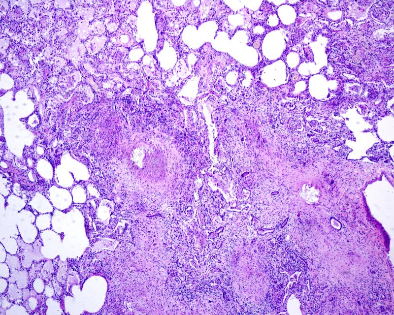 Lung Cells Emphysema Stock Photos - Free & Royalty-Free Stock Photos ...