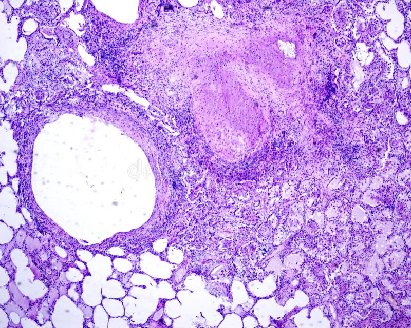 Lung Cells Emphysema Stock Photos - Free & Royalty-Free Stock Photos ...