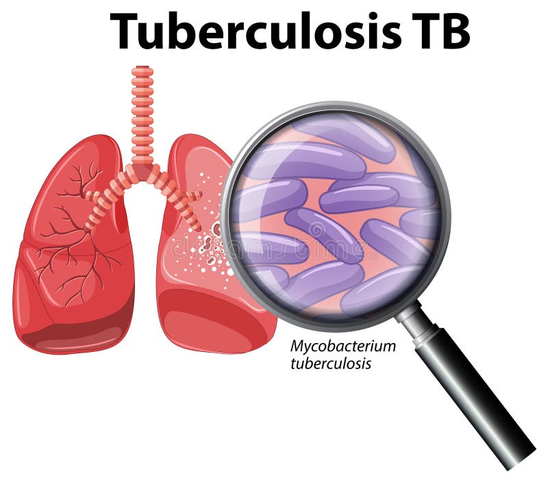 Tuberculosis in Human Lungs Stock Vector - Illustration of clipart ...