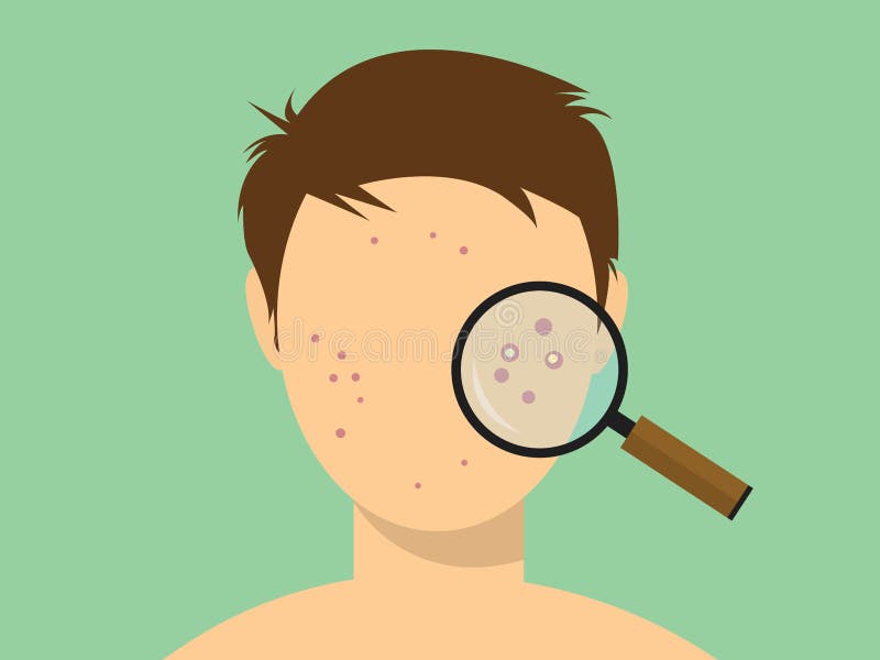 Acne Boy Stock Illustrations – 247 Acne Boy Stock Illustrations ...
