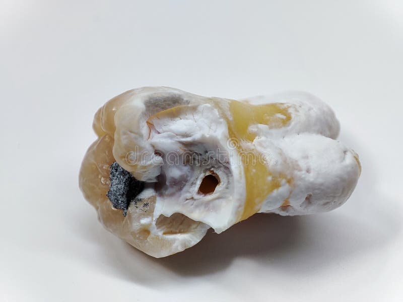 Human Molars with Large Cavities Stock Photo - Image of healthcare ...