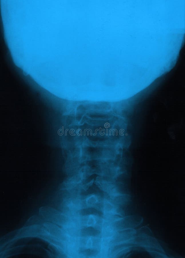 Human neck stock image. Image of roentgen, clinic, report - 22049957