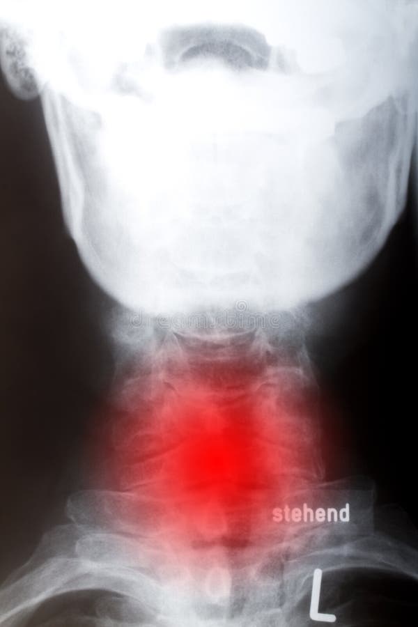 Human neck in front stock photo. Image of report, roentgen - 96427064