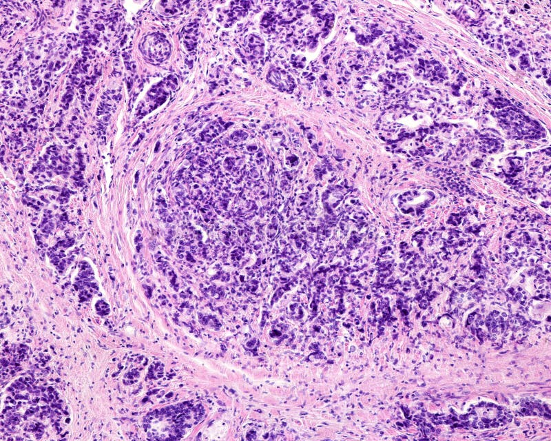 Human Prostate Cancer. Adenocarcinoma Stock Photo - Image of ...