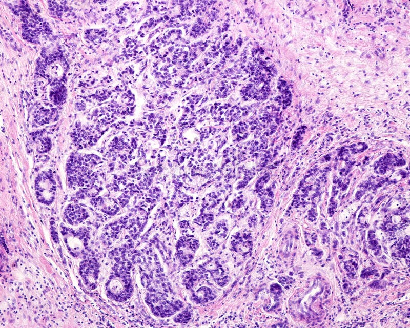 Human Prostate Cancer. Adenocarcinoma Stock Photo - Image of prostate ...