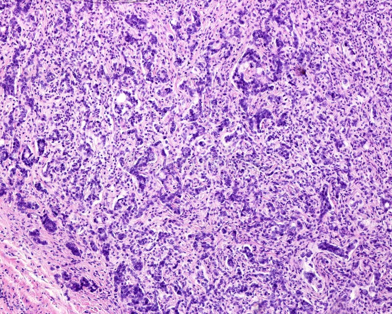 Human Prostate Cancer. Adenocarcinoma Stock Photo - Image of cancerous ...