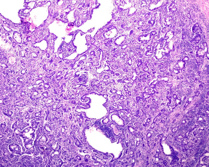 Human Prostate Cancer. Adenocarcinoma Stock Image - Image of oncology ...