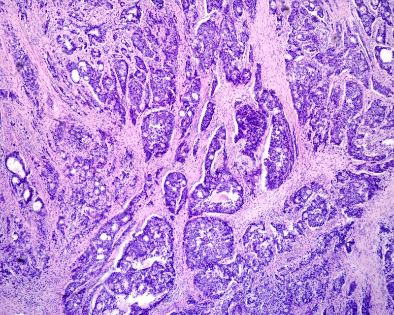 Human Prostate Cancer. Adenocarcinoma Stock Photo - Image of microscopy ...